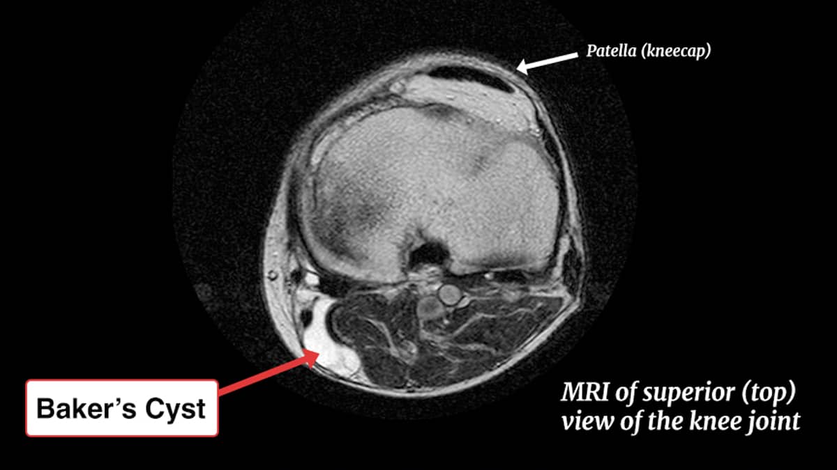 Two Cysts Around the Knee: Meniscus Cyst or Baker's Cyst Treatment